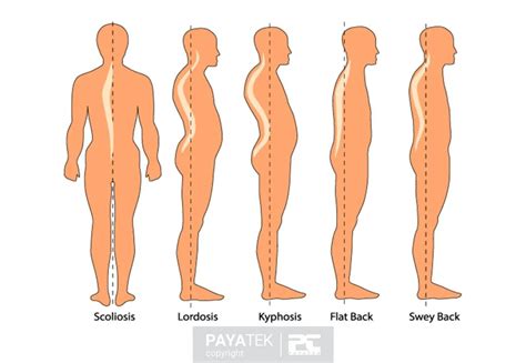 Types Of Postural Abnormalities Symptoms Prevention Treatment