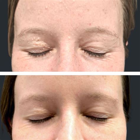 Milia Removal Brisbane Professional Milia Extraction Facial