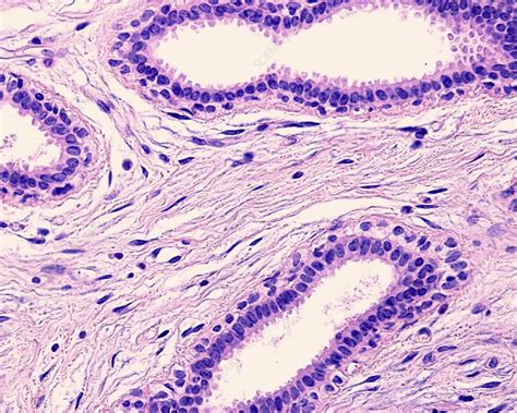 Adenosis Of Human Breast Light Micrograph Stock Image C046 4331