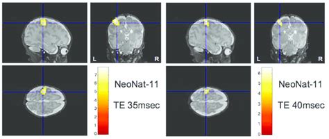 Activation Of The Sensorimotor Cortex Two Successive Fmri Runs With Download Scientific