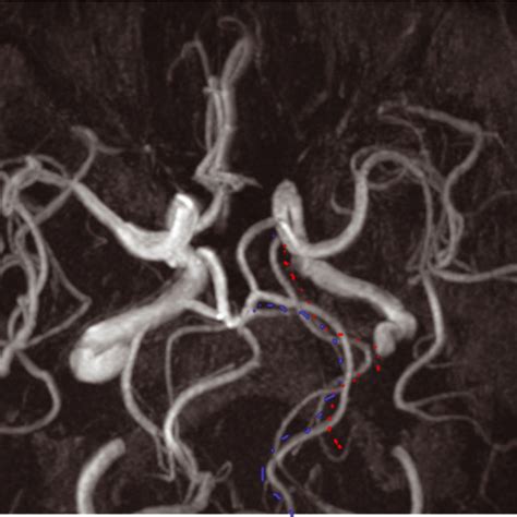 Three Dimensional Magnetic Resonance Angiography Reconstruction The