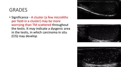 Testicular Microlithiasis Pptx