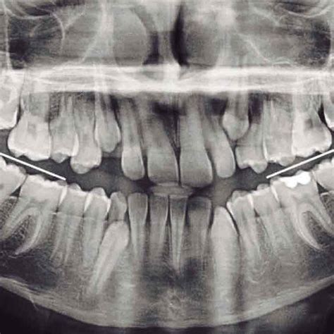 An OPT Image Of An Adult Female Note That Deepest Flexure Point On Download Scientific Diagram