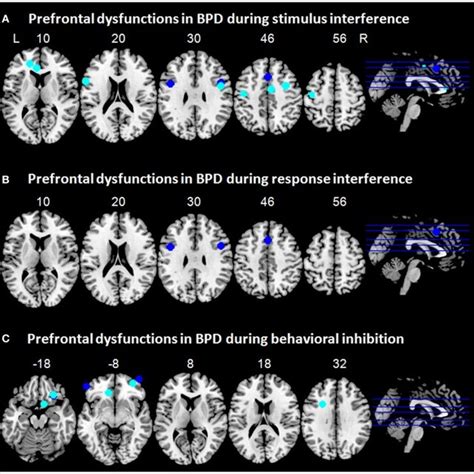 Prefrontal Dysfunctions In Attention Deficit Hyperactivity Disorder Download Scientific
