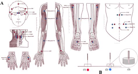 Full Article The Efficacy And Safety Of Electroacupuncture For