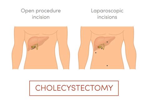 Cholecystectomy Guide