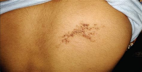 Epidermolytic Nevus An Instance Of Mosaic Epidermolytic Ich Indian Dermatology Online Journal