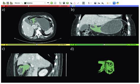 a volumetric manual segmentation performed with 3d slicer software