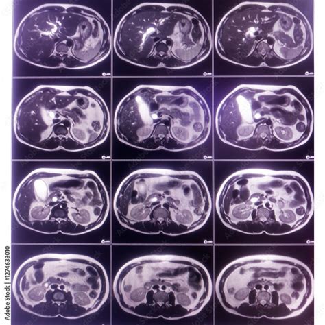Mrcp Film Of Mri Of Abdomen Hepatic Parenchymal Tiny Calcification Hepaticolithiasis Liver