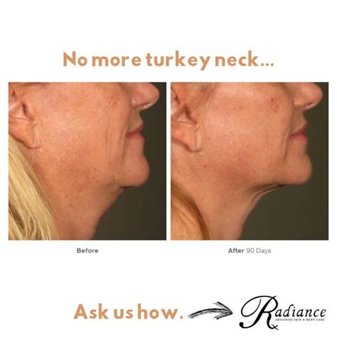 November Special On Ultherapy Treat Your Neck In Time For Thanksgiving