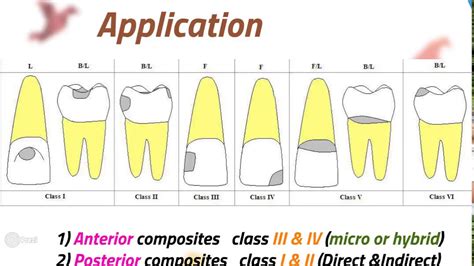 Dental Composite Part 24 Youtube