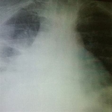 Native Lung Rtg On One Year After Surgery Download Scientific Diagram