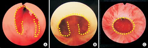 Aggressive Diagnosis And Treatment For Posterior Urethral Valve As An