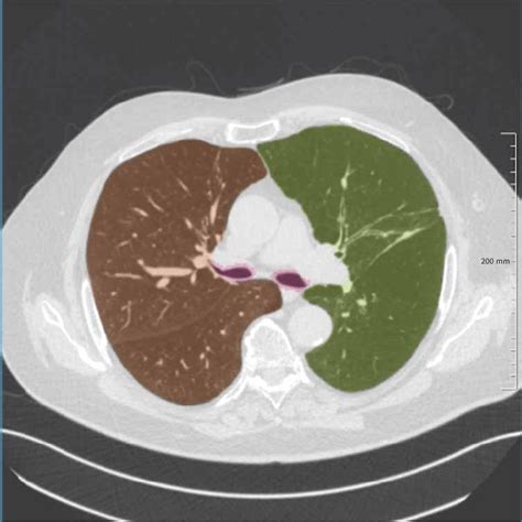 Example Of Chest Computed Tomography Ct Lung Segmentation The Figure Download Scientific