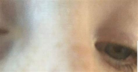 Tiny Scab On Mum S Nose That She Ignored For A Year Was Deadly Skin Cancer Mirror Online