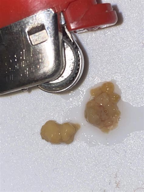 My Left Tonsil Pt 2087643 Scrolller