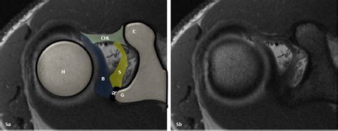 Figure 1 From Anatomy And Pathology Of The Rotator Interval At Mr Arthrography Semantic Scholar