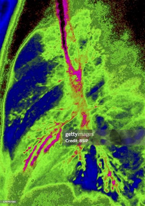 Bronchiectasis X Ray Bronchial Dilatation Pulmonary X Ray In Front News Photo Getty Images