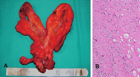 The Gross Appearance Of Atrophic Gist A And Pathological Finding Of