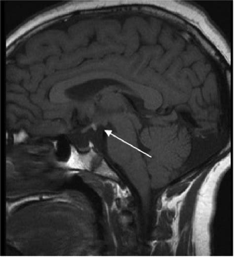 Homozygous Cdh2 Variant May Be Associated With Hypopituitarism Without Neurological Disorders In