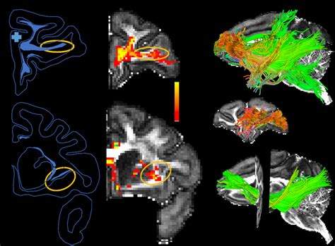 Tractography Derived Fiber Bundles In Comparison With The Anatomical