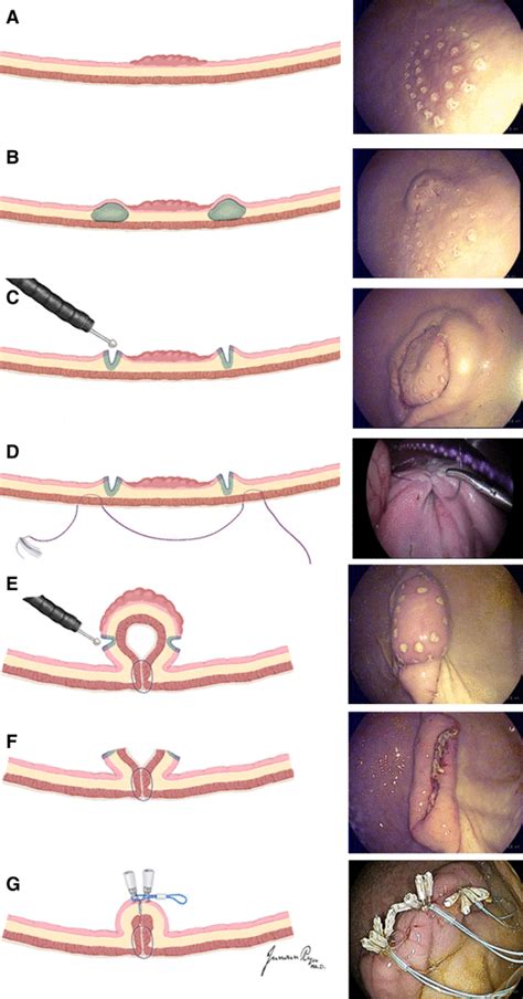 Non Exposure Simple Suturing Endoscopic Full Thickness Resection
