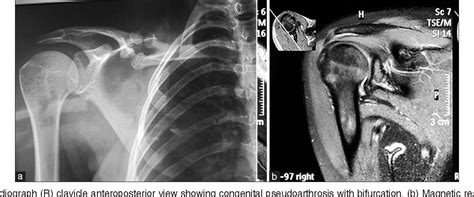 Congenital Pseudoarthrosis Semantic Scholar