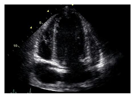 Echocardiography Showing Septal Bouncing A Dilation Of Ivc B