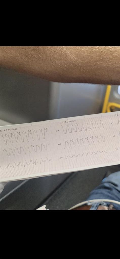 Is This A Sign Of Afib R AFIB