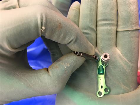 Big Toe Fusion London Sports Orthopaedics