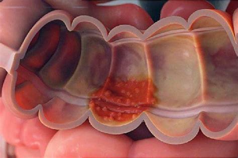 Ulcerative Colitis Treatment In Pune Kaizen Gastro Care