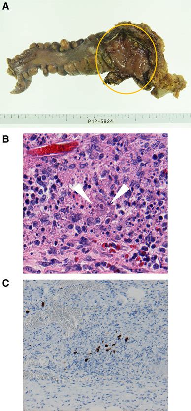 The Pathology Of Resected Sigmoid Colon With The Perforation The Download Scientific Diagram