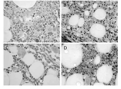 Figure 1 From Bone Marrow Involvement In Systemic Lupus Erythematosus Semantic Scholar