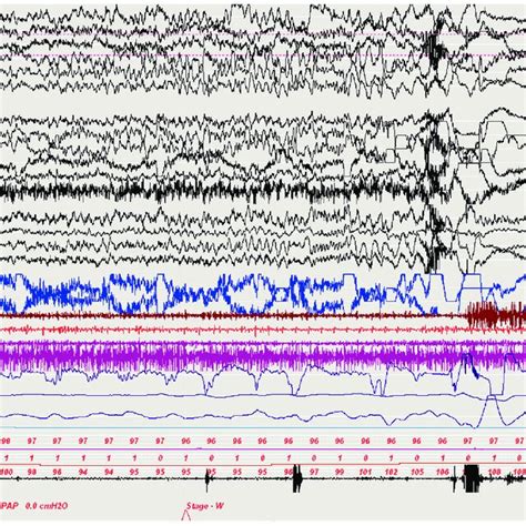 Temporal And Spatial Propagation Of The Sharp Wave Activity That Download Scientific Diagram