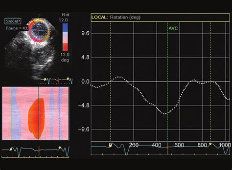 Reversed Apical Rotation In Patient Of Dilated Cardiomyopathy Download Scientific Diagram