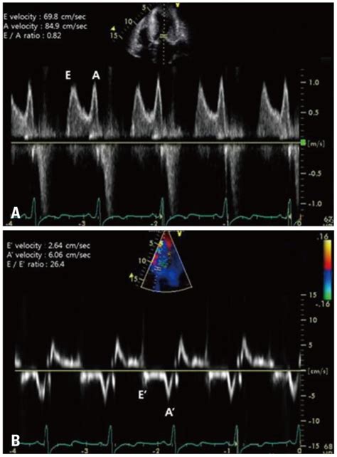 Pulse Waved Doppler Echocardiography A And Tissue Doppler Download Scientific Diagram