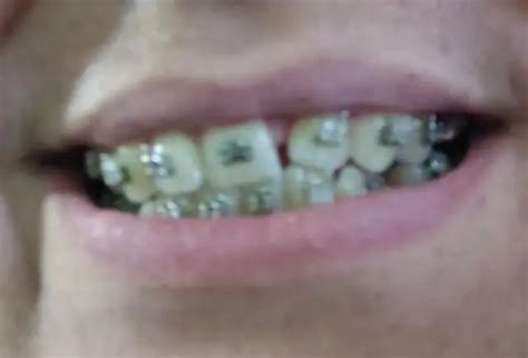 Opening Up My Gap To Place An Implant Scrolller