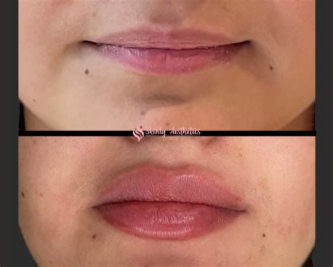 Russian Lip Filler Before And After Results Skinly Aesthetics