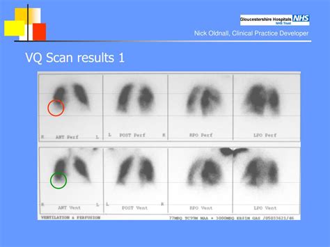 Ppt An Introduction To Pulmonary Embolus Powerpoint Presentation Free Download Id 6258779
