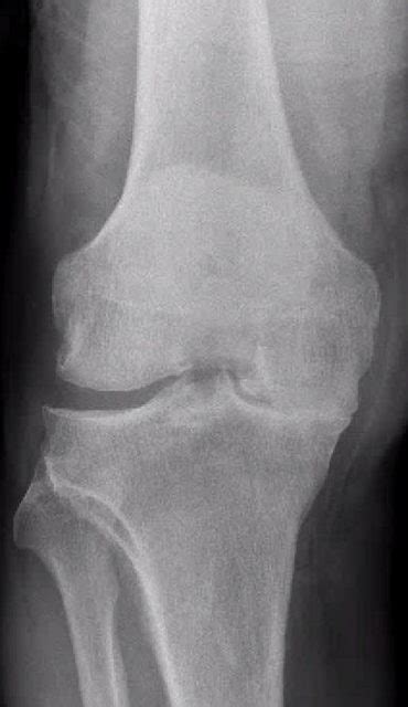 Partial Knee Replacement Alexlee