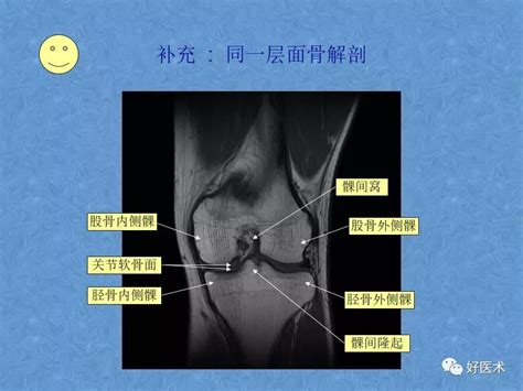 膝关节MRI高清解剖及疾病诊断图解此课件推荐收藏 MedSci cn