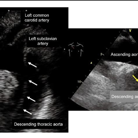 Comprehensive Assessment Of Paradoxical Low Flow Low Gradient Severe