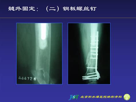 髋关节置换术后股骨假体周围骨折的诊治策略 好医术早读文章 好医术 赋能医生守护生命