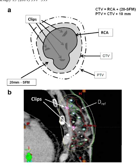 Oncoplastic Partial Mastectomy Lumpectomy With Oncoplastic Closure Semantic Scholar