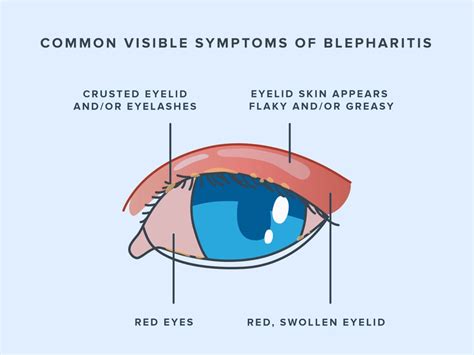 Blepharitis Red Swollen Eyelids Causes Symptoms Treatments Howtodoes