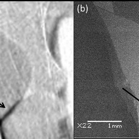 Pdf Marginal Leakage Of Class V Composite Restorations Assessed Using Microcomputed Tomography