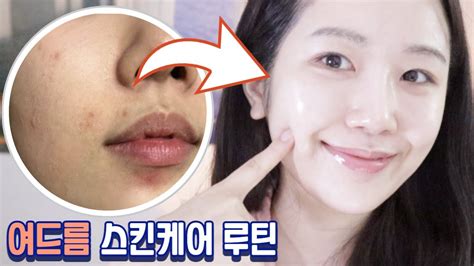 갑자기 여드름 피부 좁쌀 여드름화농성 여드름 압출부터 흉터관리까지 스킨케어 루틴 인생 처음 피부과 썰 이벤트 Youtube