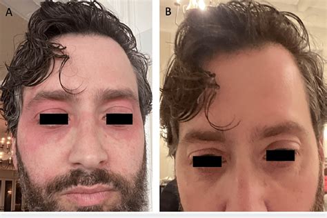 Non Scaly Erythematous Patches In Peri Ocular Areas Bilaterally A
