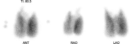 99m Technetium Pertechnetate Scintigraphy Scan Showing An Enlarged