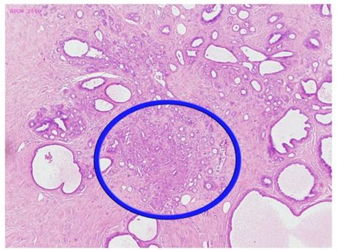 adenosis and sclerosing lesions flashcards quizlet